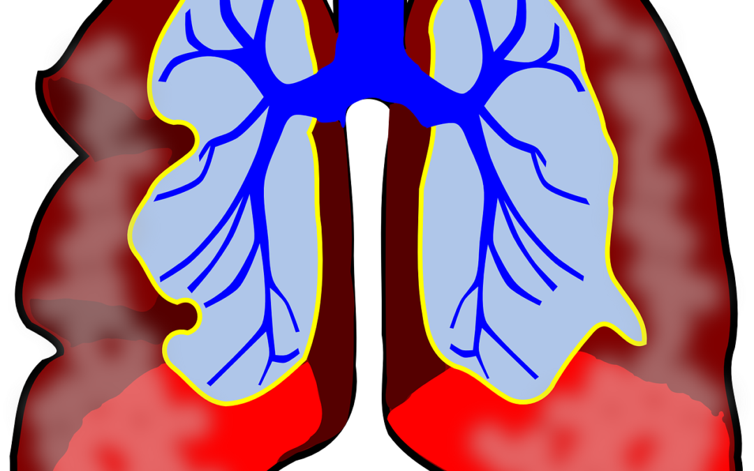 What Is Broncho Pulmonary Dysplasia? | Medical Health Articles Today